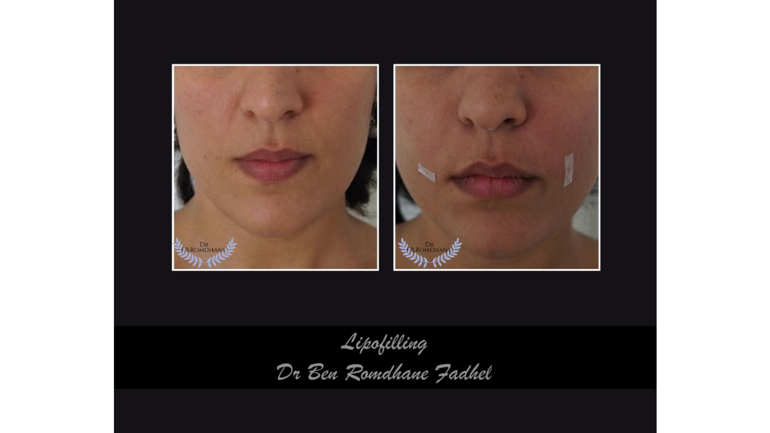 Lipofilling – Docteur Ben Romdhane